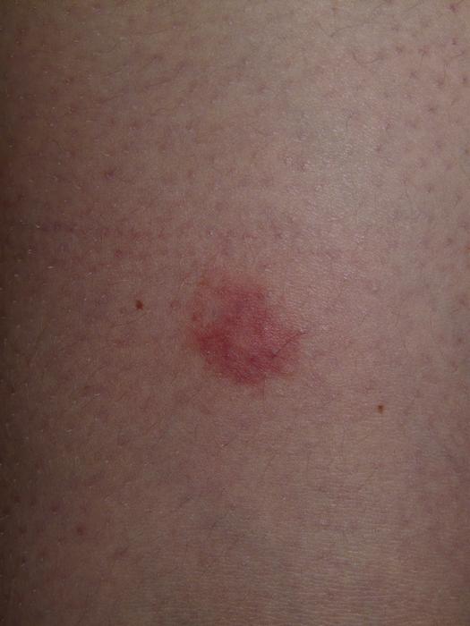 Redness at the injection site free image download