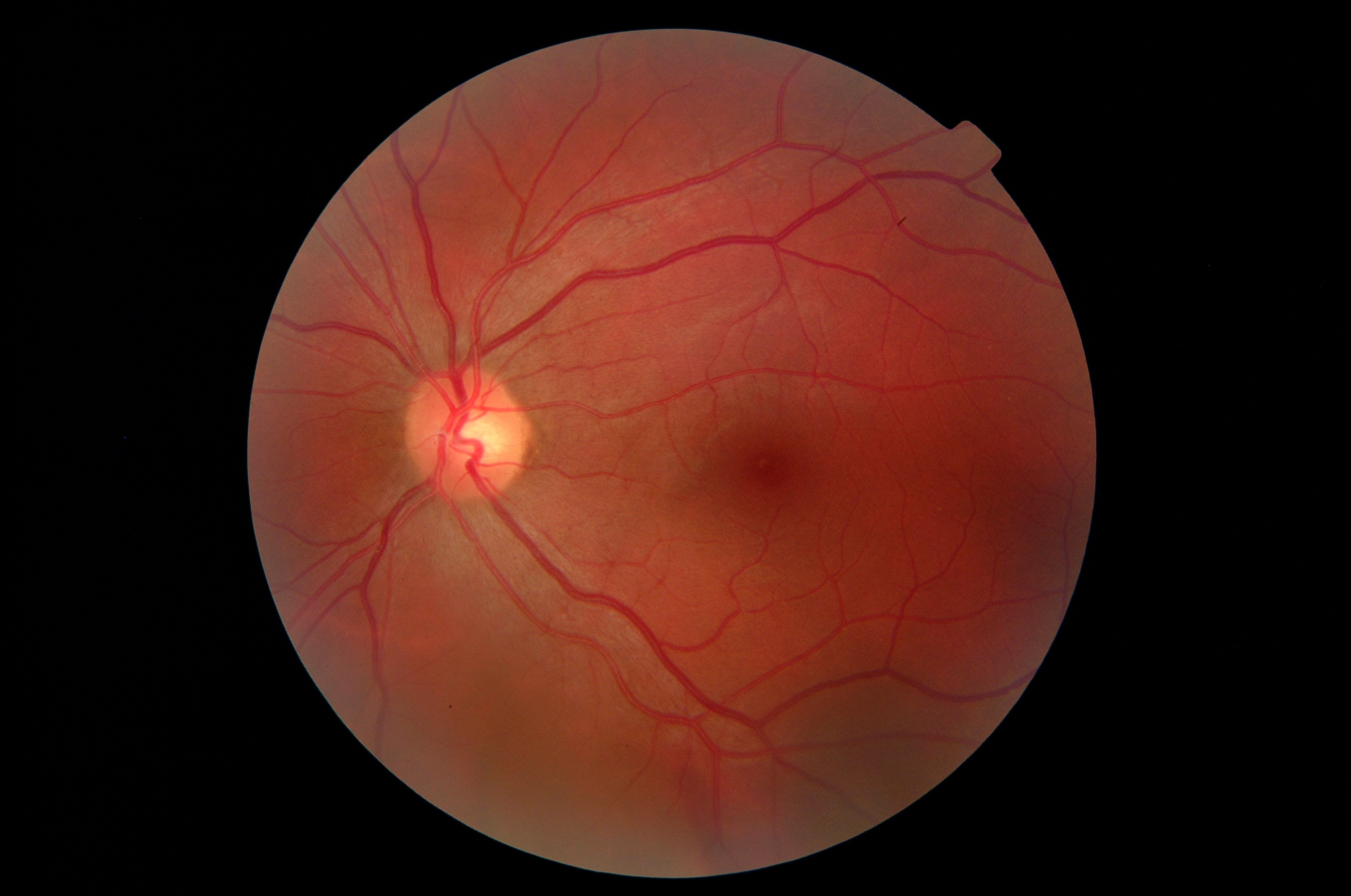 Eye Fundus free image download